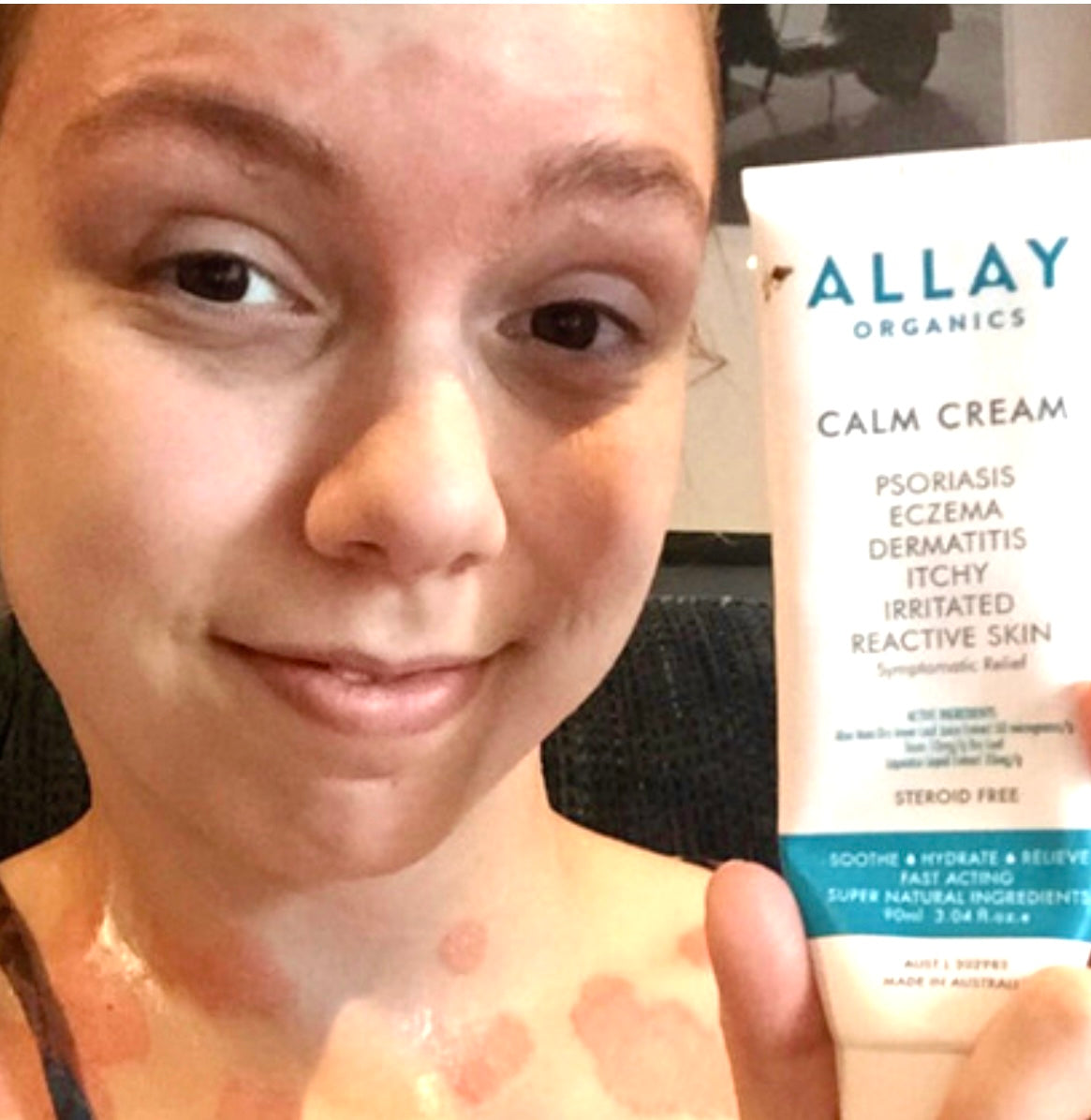 Calm Cream- Best Natural Cream For Psoriasis, Eczema and Dermatitis ...