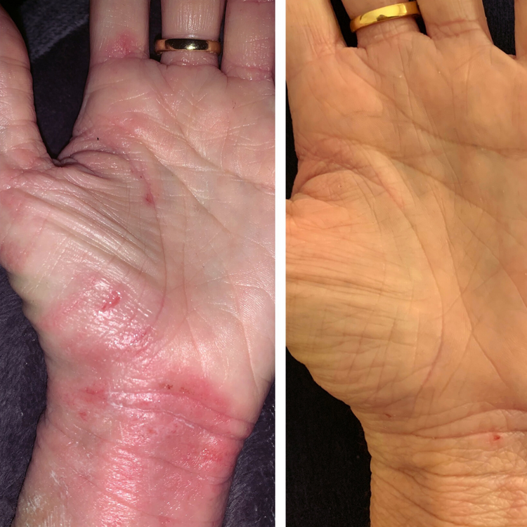 Calm Cream- Best Natural Cream For Psoriasis, Eczema and Dermatitis ...